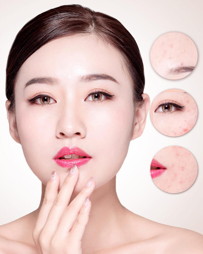 100 Mins Acne Facial Treatment | Coslab Beauty Spa