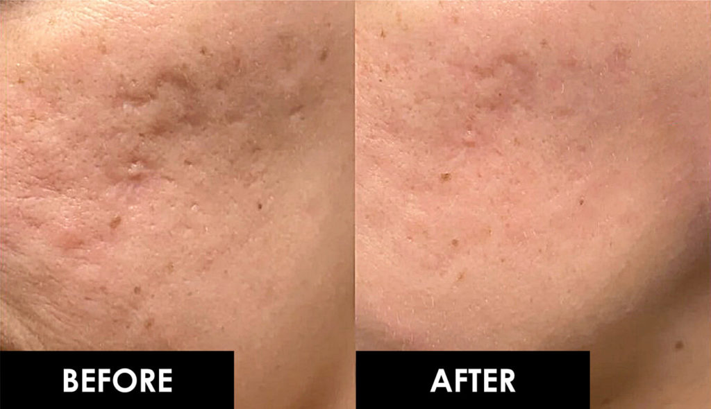 Microneedling Singapore - Best Acne Scar Removal Facial Treatment RF at ...