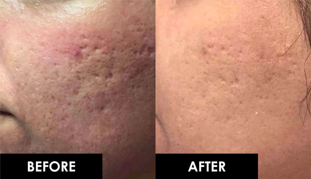 Microneedling Singapore - Best Acne Scar Removal Facial Treatment RF at $98 - Coslab